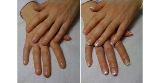 A Before and After Picture Set Regarding 'Nails